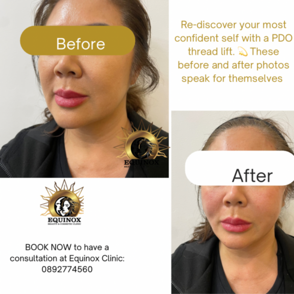 Pdo mono threads jaw,non-surgical eyelid,neck lift Perth-equinox
